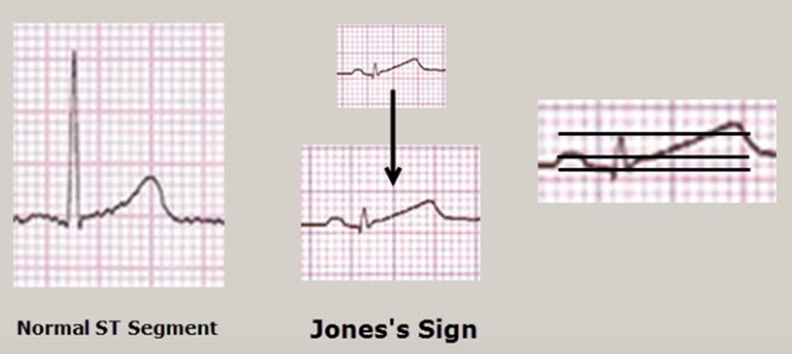 Jones's Sign - Advanced ECG Courses