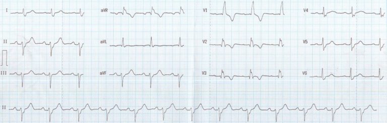  Oreilles De Lapin Et Bloc De Branche Droit Cours D ECG Avanc s 