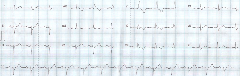  Rabbit Ears And Right Bundle Branch Block Advanced ECG Courses