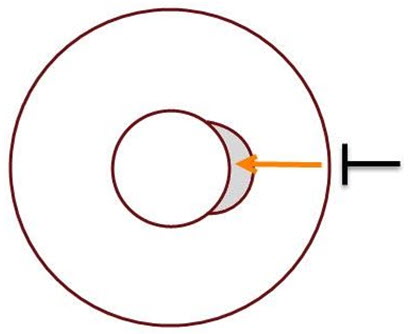 Systolic and Diastolic Currents of Injury | Advanced ECG Courses