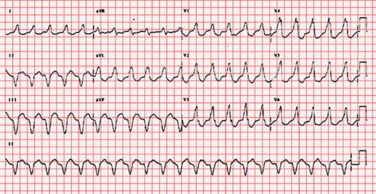 Precordial Concordance in VT | Advanced ECG Courses