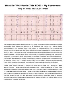 What Do YOU See in This ECG - My Comments - Advanced ECG Courses